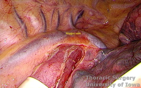 Esophagectomy: Three-field (McKeown) - Laparotomy and Right Thoracoscopy (Thoracotomy) with ...